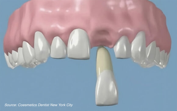 Knocked-Out-Tooth - Atria-City Dental Group